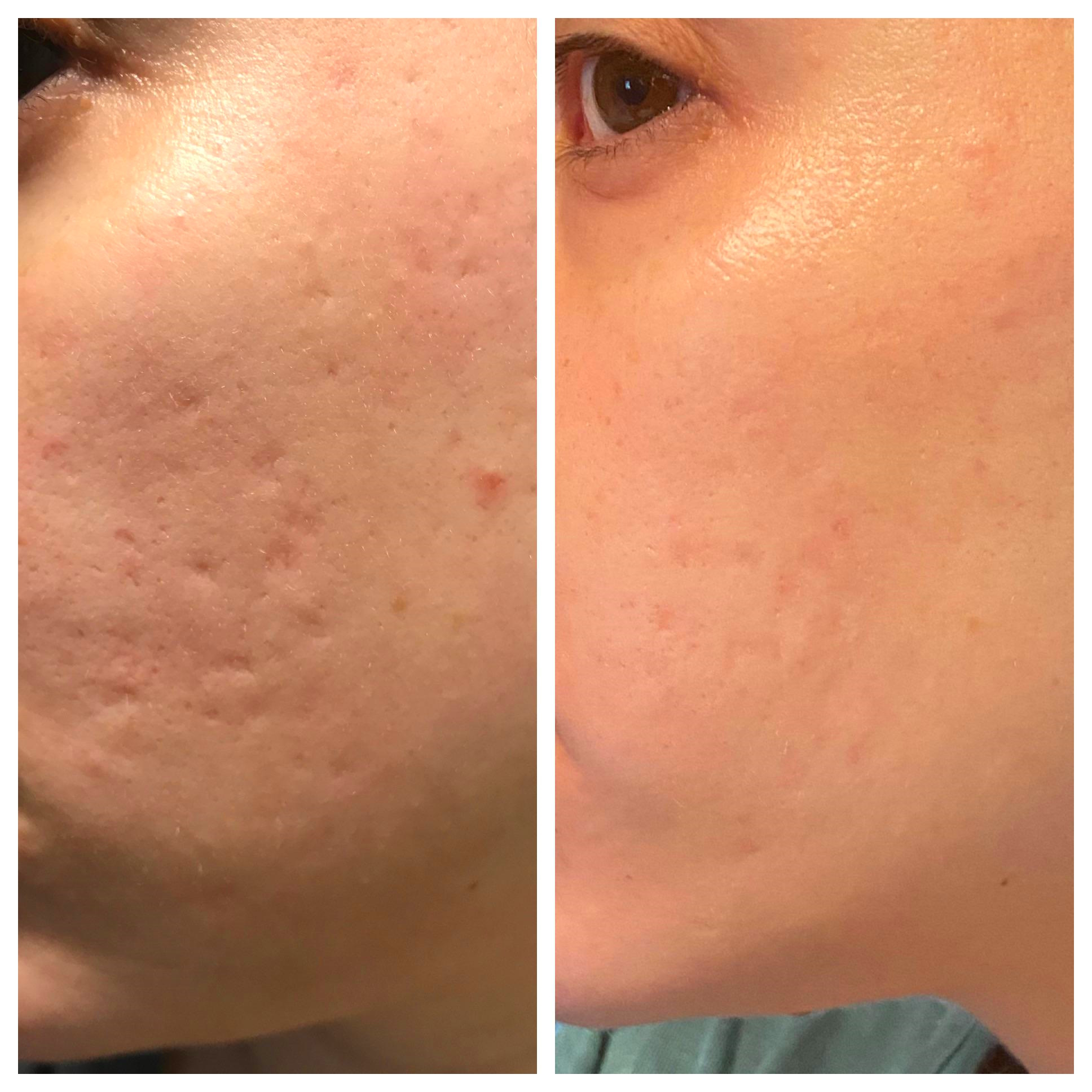 Removing Acne Scars - Exotica Skin Care